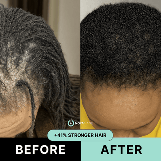 NovaMane Hair Regrowth Micro-Infusion System For Women