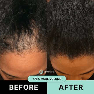 NovaMane Hair Regrowth Micro-Infusion System For Women